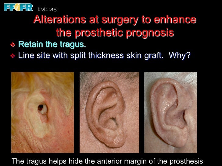 Restoration of Facial Defects - Basic Priniciples