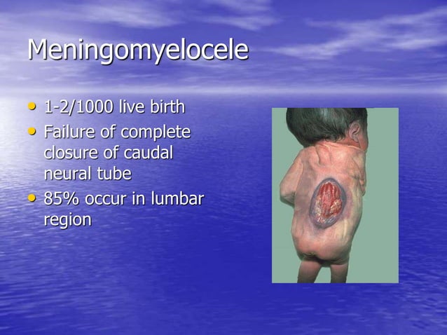 Disorders of neural tube | PPT