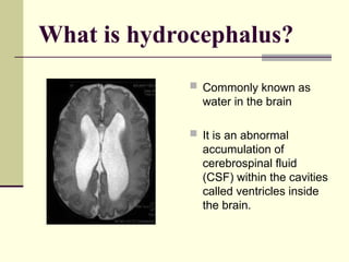 Hydrocephalus and it's types in children | PPT