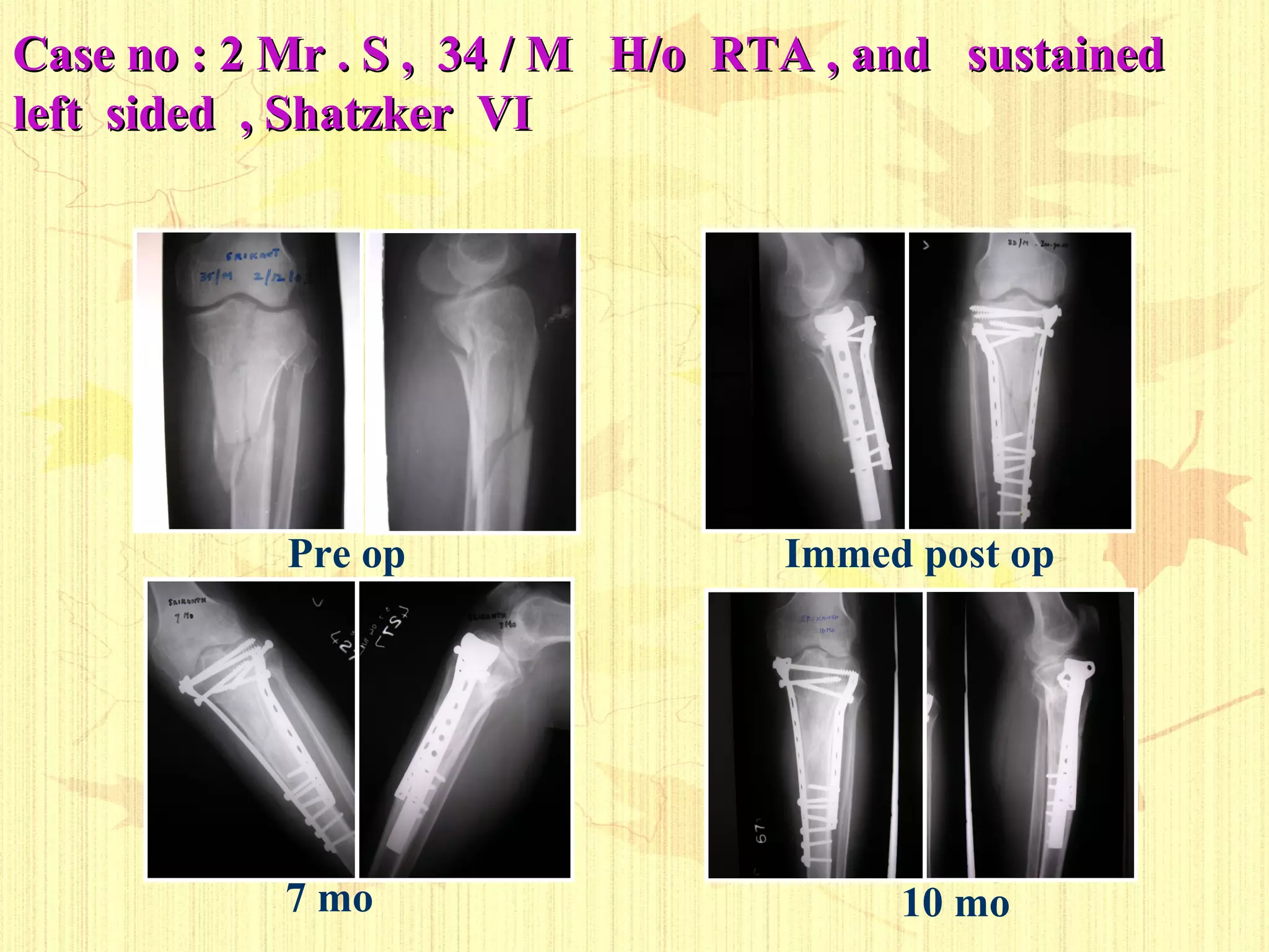 Analysis of Tibial Condyle Fractures Treated by minimally Invasive ...