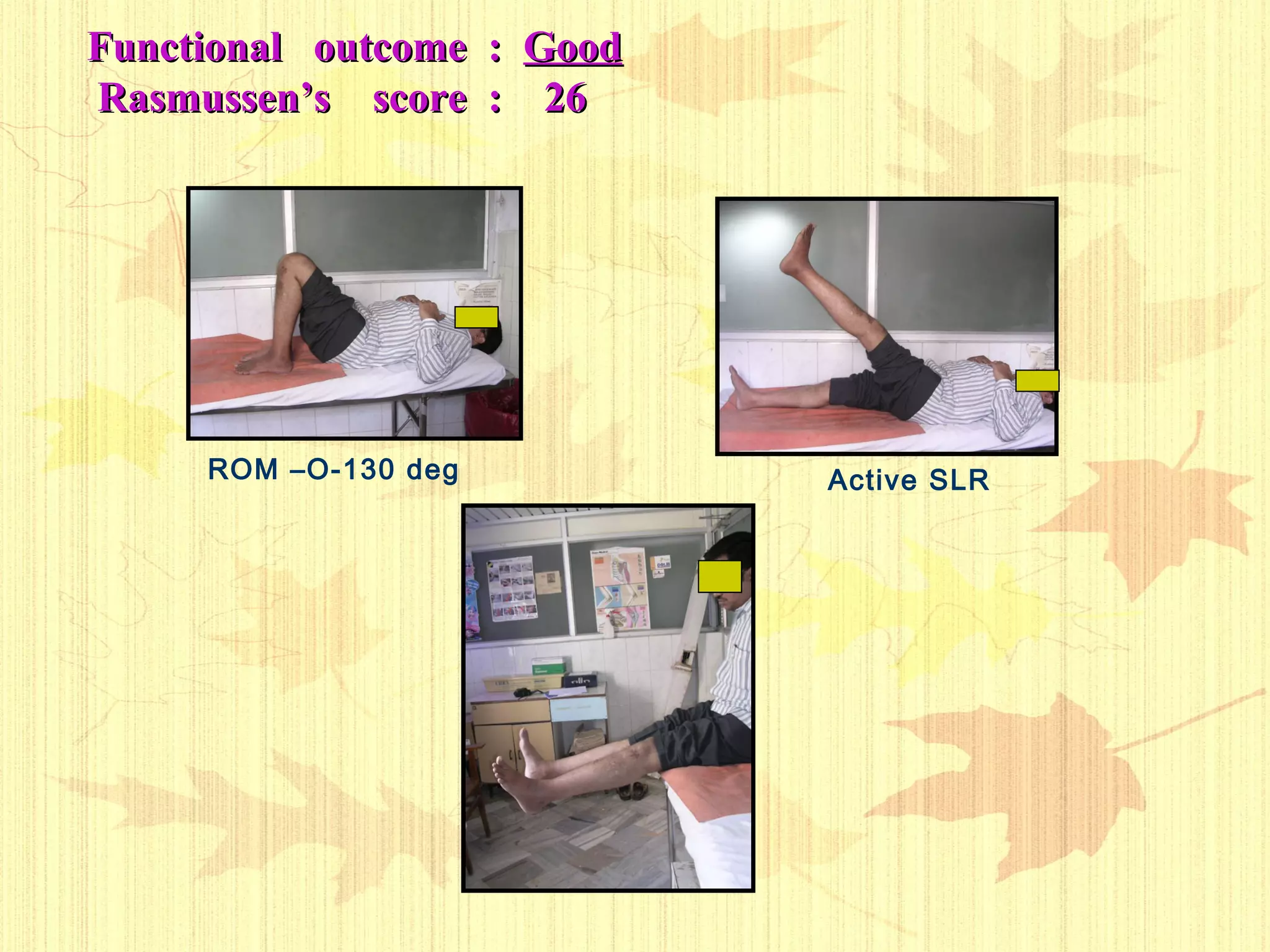 Analysis of Tibial Condyle Fractures Treated by minimally Invasive ...