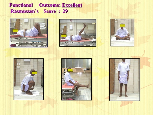 Analysis of Tibial Condyle Fractures Treated by minimally Invasive ...