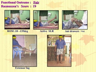 Analysis of Tibial Condyle Fractures Treated by minimally Invasive ...