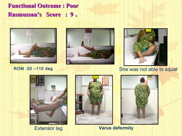 Analysis of Tibial Condyle Fractures Treated by minimally Invasive ...