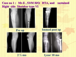 ANALYSIS OF TIBIAL CONDYLE FRACTURES TREATED BY MINIMALLY INVASIVE ...