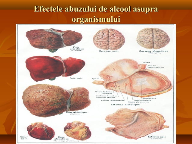 alcoolul-binecuvantare-sau-blestem | PPT