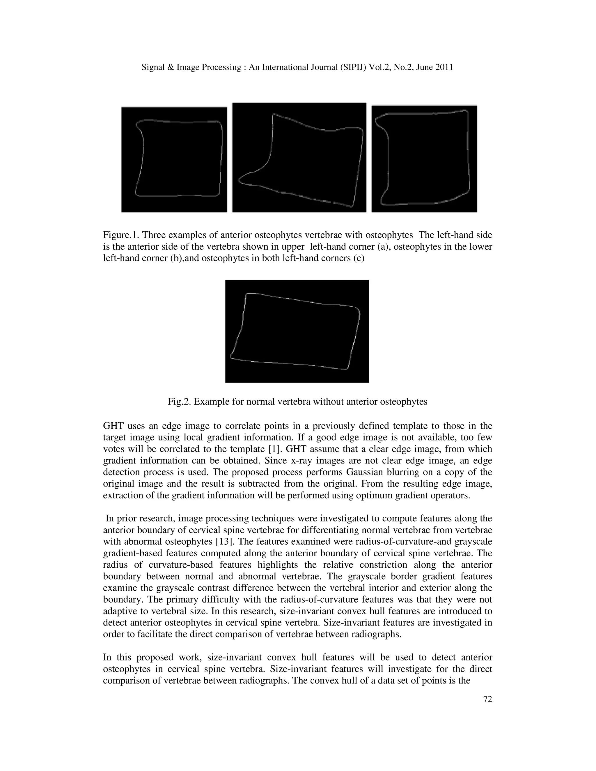 Anterior Osteophyte Identification in Cervical Vertebrae | PDF
