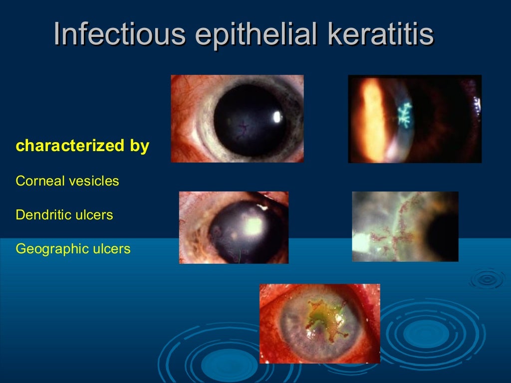keratitis viral