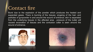 Forensic BALLISTICS # Identification of range of fire through wound ...