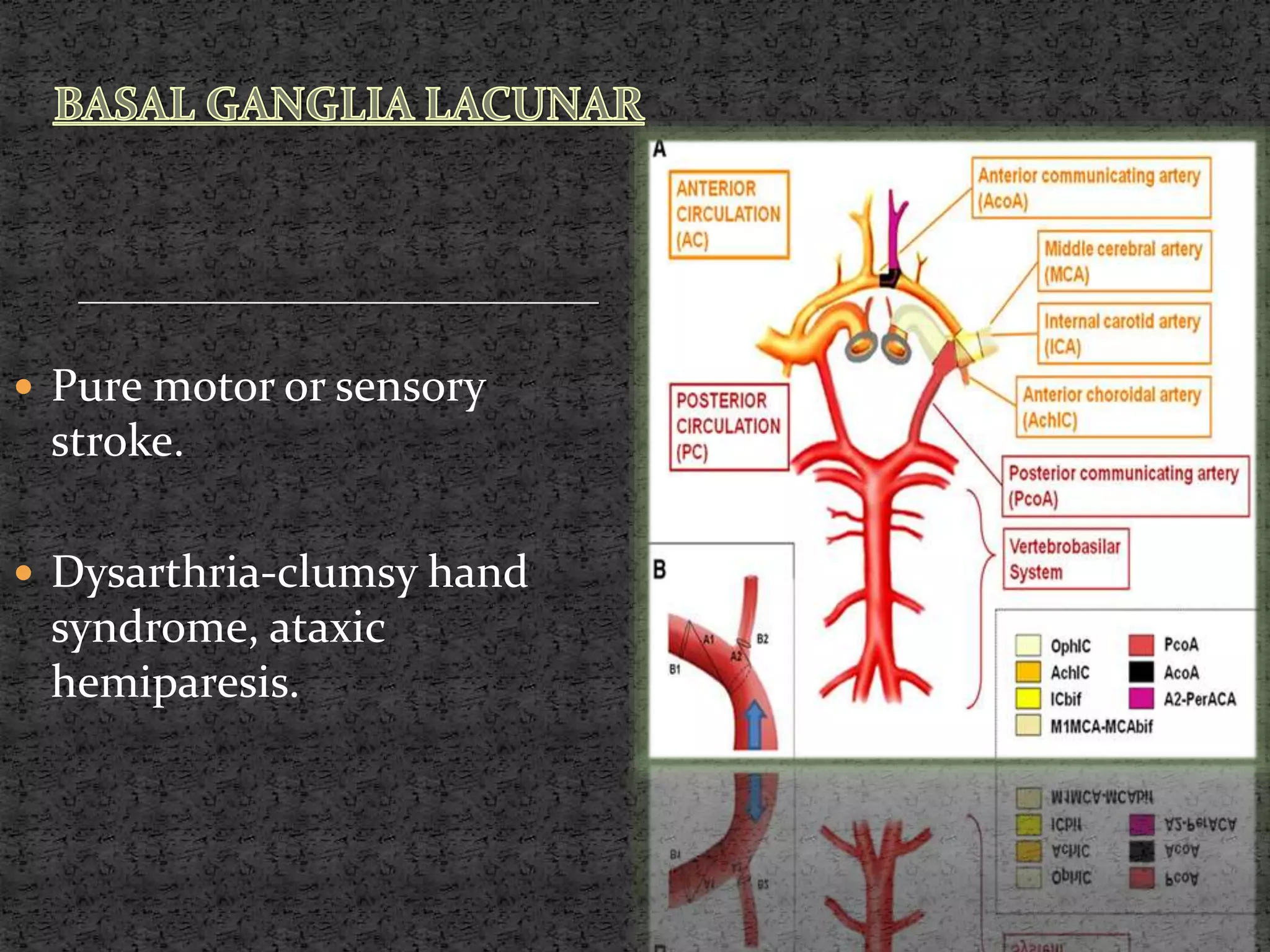 stroke ( ischemic stroke ) | PPTX