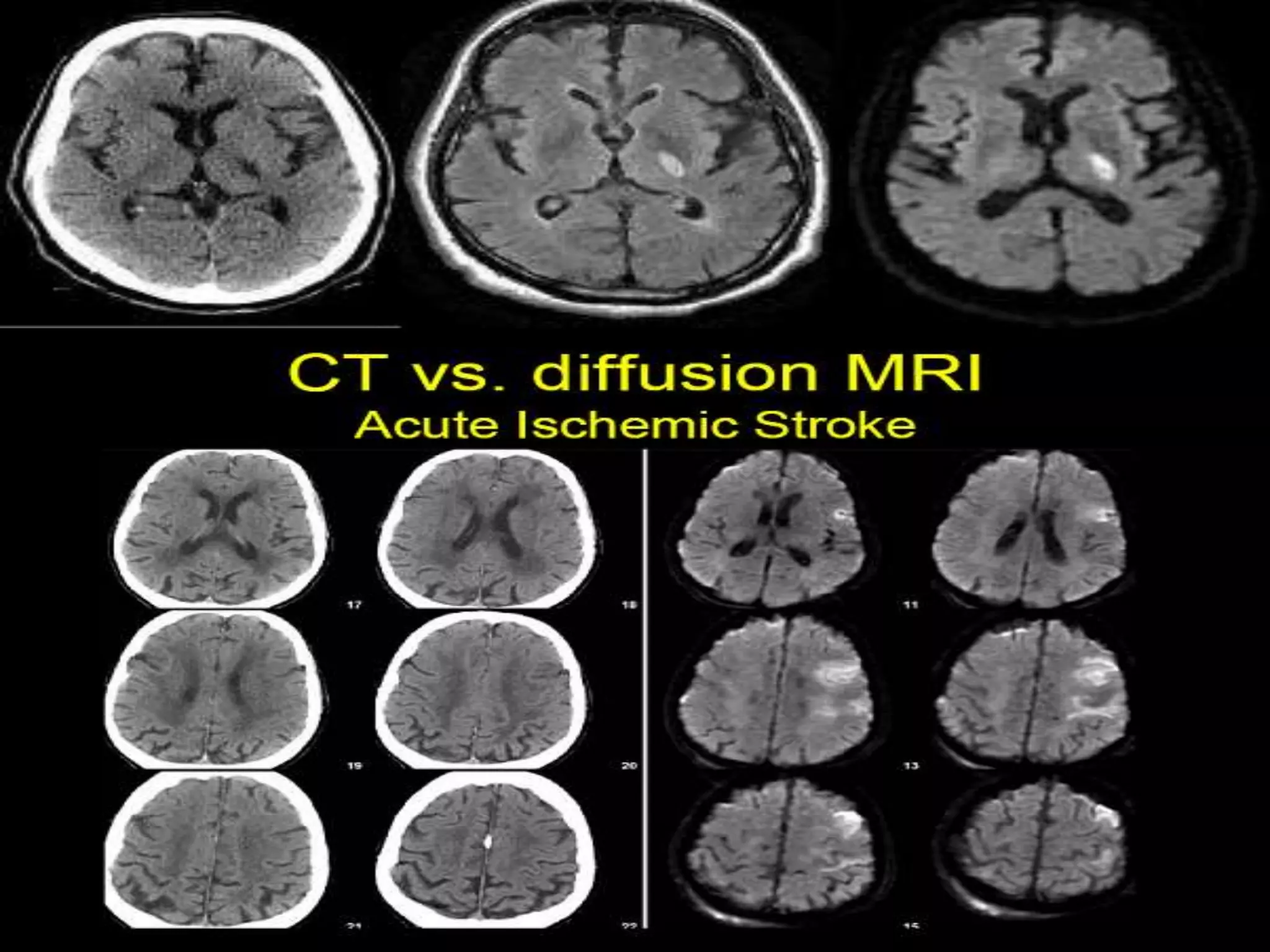 stroke ( ischemic stroke ) | PPTX