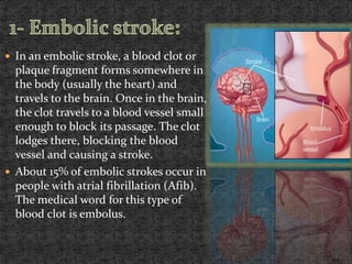 stroke ( ischemic stroke ) | PPTX