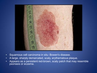 222821042 squamous-cell-carcinoma | PPTX