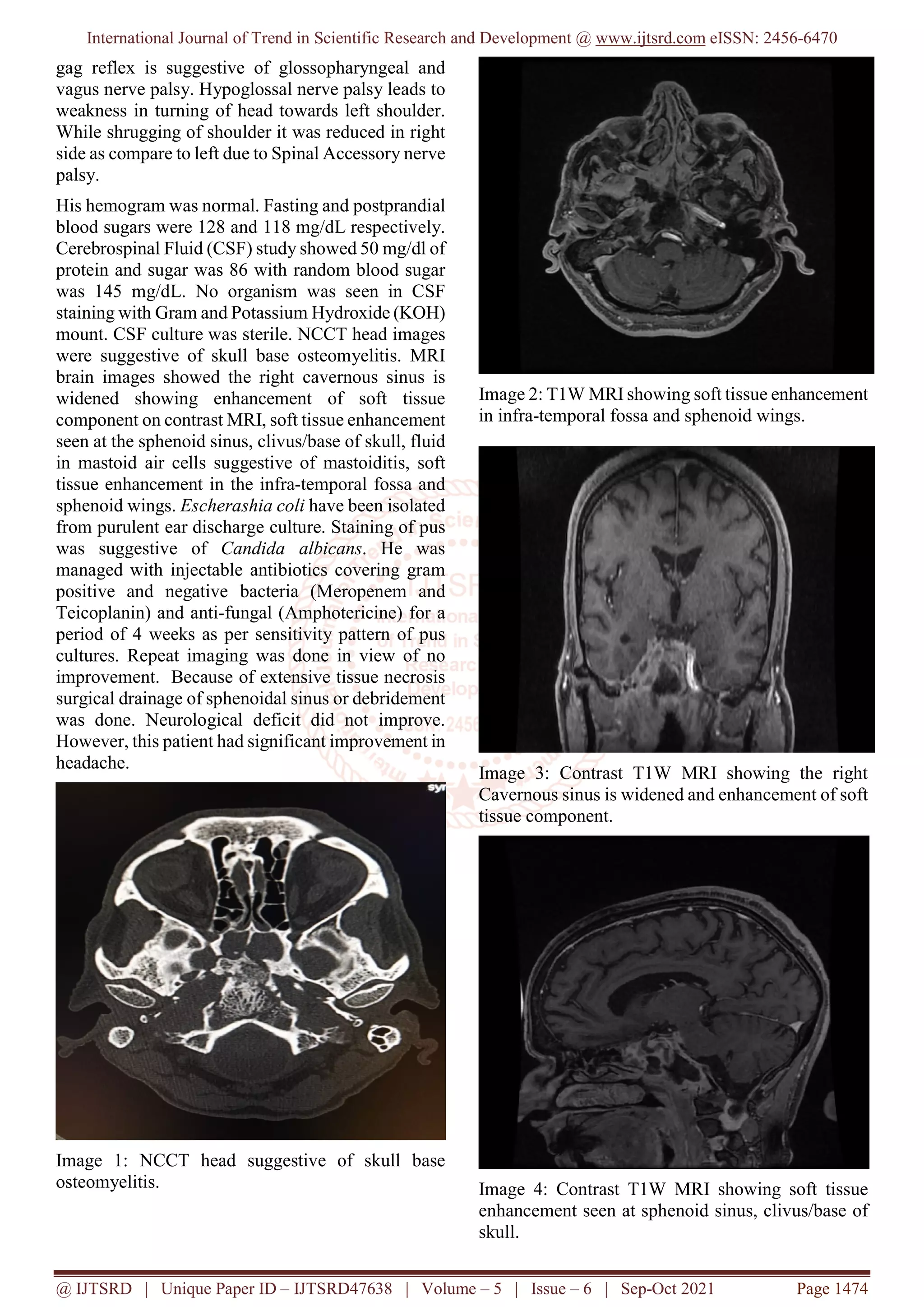 A Case of Multiple Cranial Nerves Palsy Post Electrocution | PDF