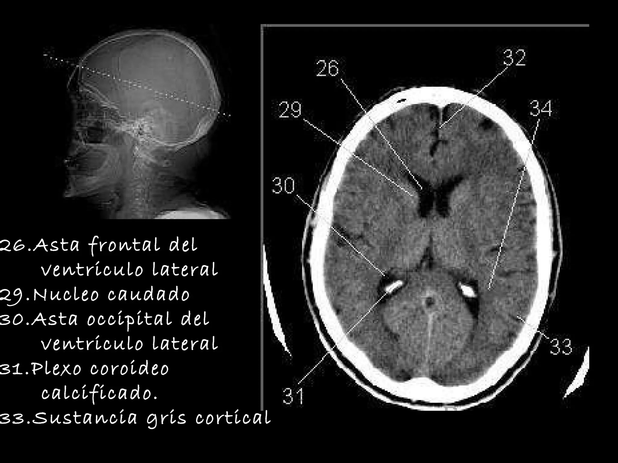 22532045 anatomia-cerebral-por-tomografia-axial | PPT | Brain and ...
