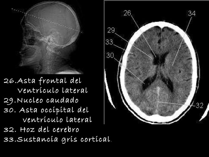 22532045 anatomia-cerebral-por-tomografia-axial