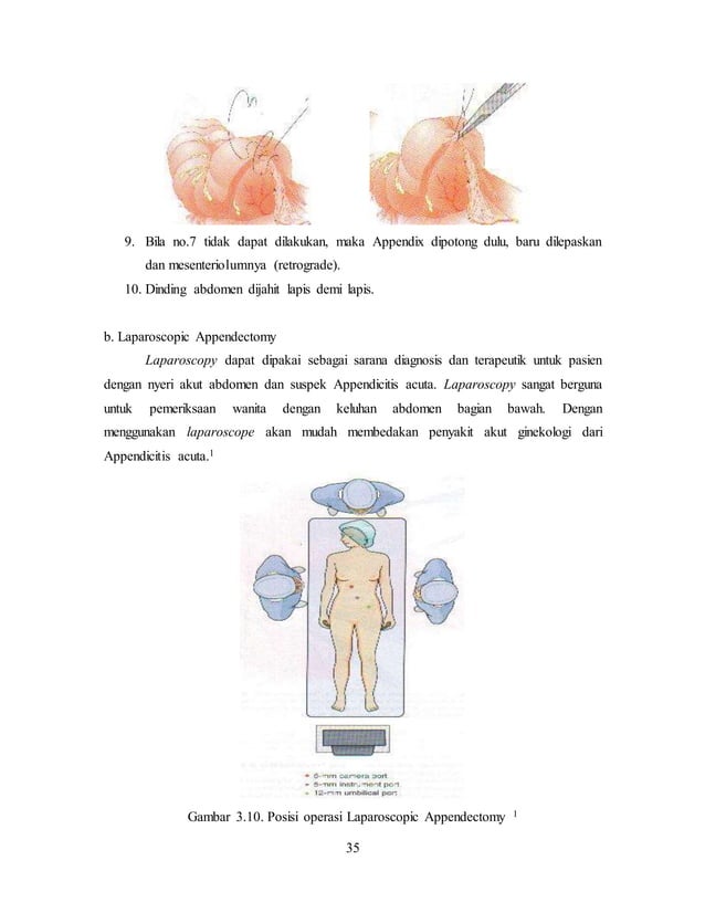 225881539 appendisitis-akut-laporan-kasus | DOC