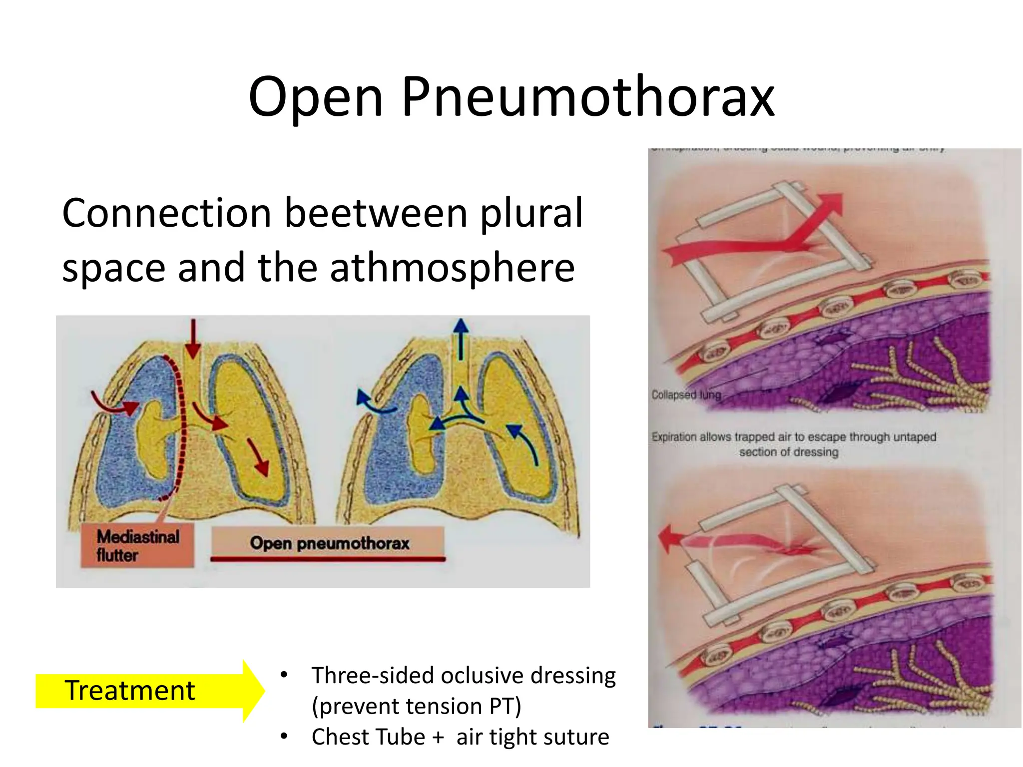 22601_Pneumothorax dan Hemothorax.pptx