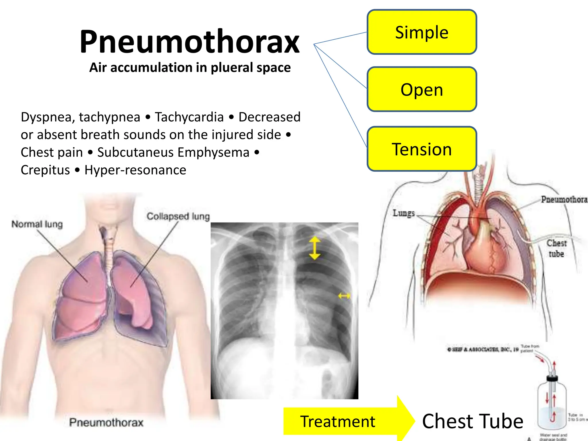 22601_Pneumothorax dan Hemothorax.pptx