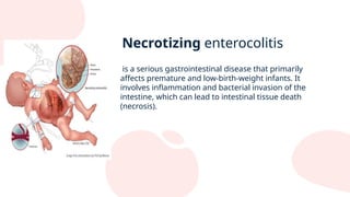 Necrotizing enterocolitis for understand.pptx