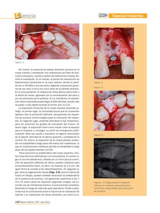 227 ciencia expansion_quirurgica_cresta_alveolar | PDF