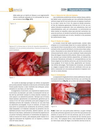 227 ciencia expansion_quirurgica_cresta_alveolar | PDF