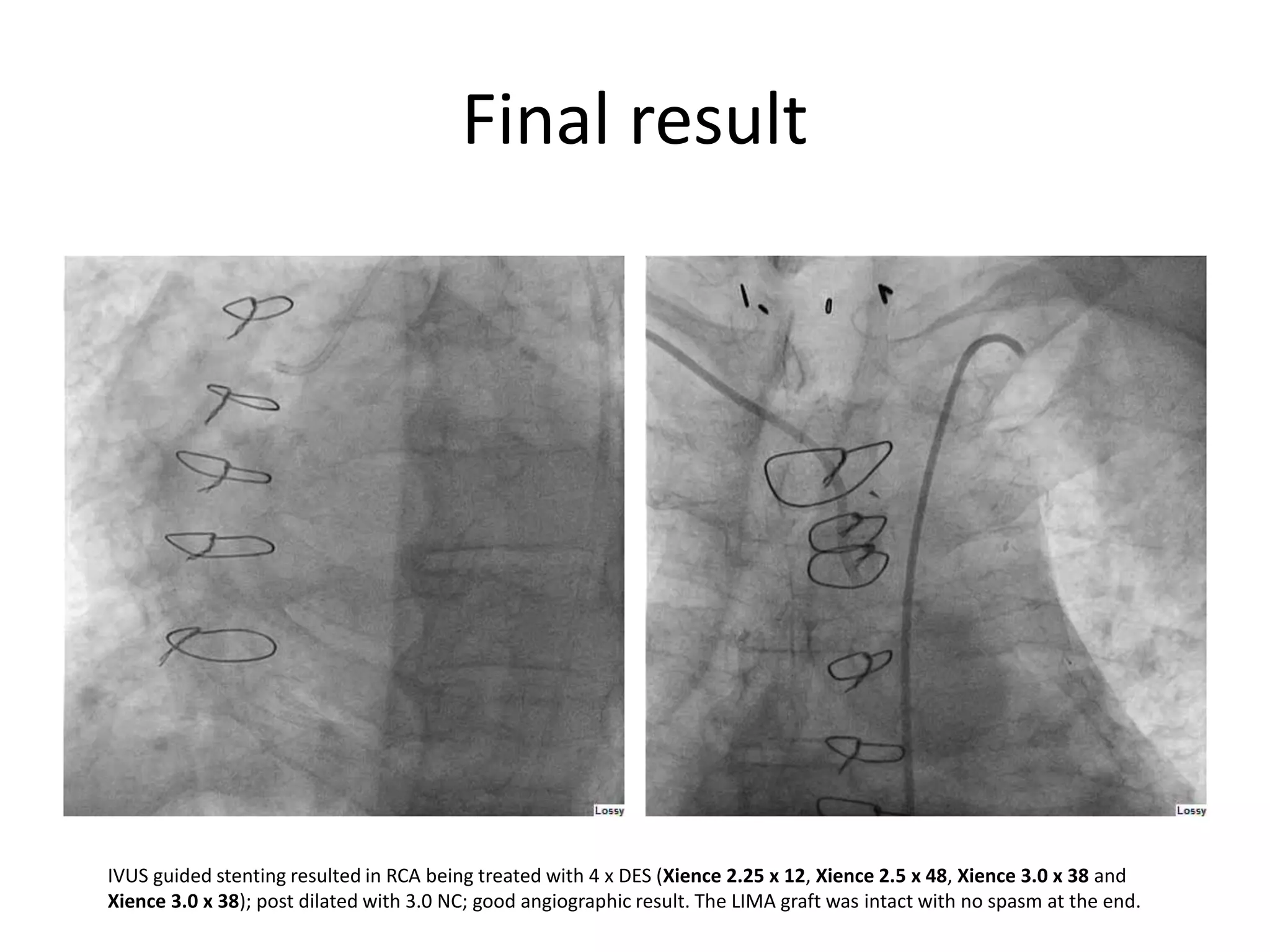 CTO PCI using LIMA as Retrograde Conduit - Saqib Ghani | PPTX