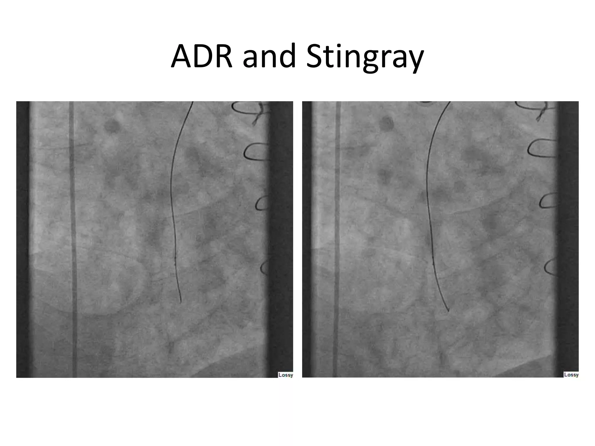 CTO PCI using LIMA as Retrograde Conduit - Saqib Ghani | PPTX