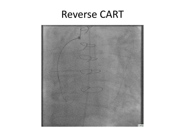 CTO PCI using LIMA as Retrograde Conduit - Saqib Ghani | PPTX