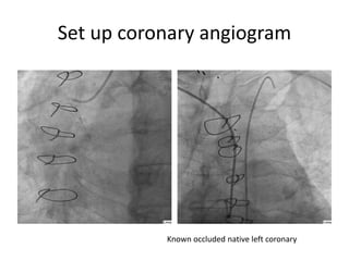 CTO PCI using LIMA as Retrograde Conduit - Saqib Ghani | PPTX