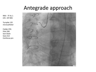 CTO PCI using LIMA as Retrograde Conduit - Saqib Ghani | PPTX