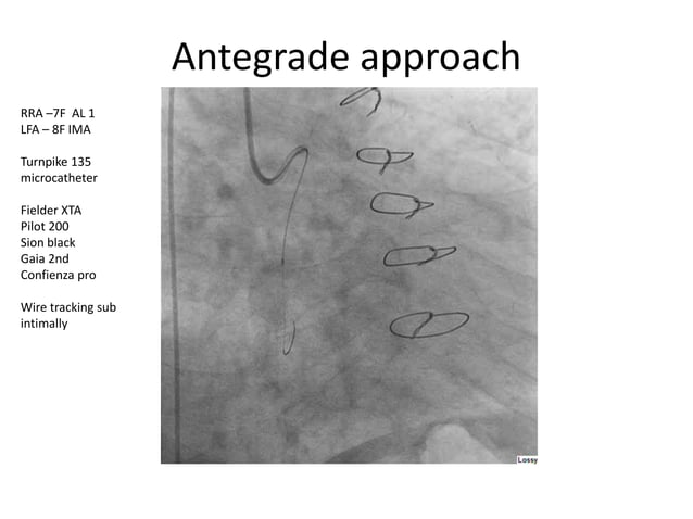 CTO PCI using LIMA as Retrograde Conduit - Saqib Ghani | PPTX