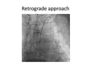 CTO PCI using LIMA as Retrograde Conduit - Saqib Ghani | PPTX