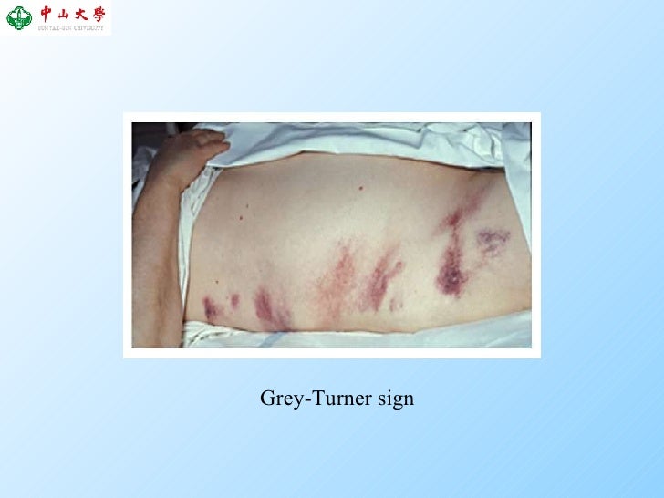 22 acute pancreatitis