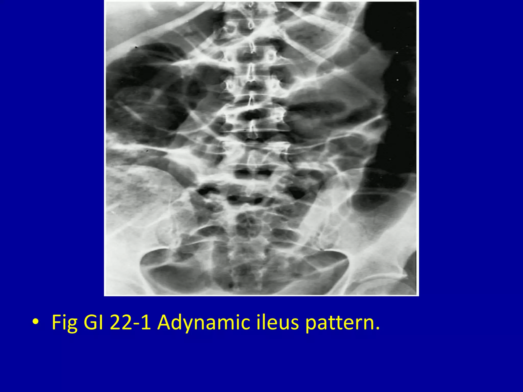 22 adynamic ileus | PPTX