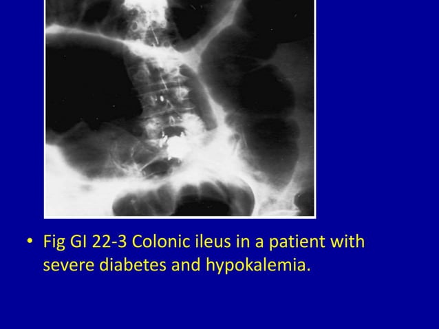 22 adynamic ileus | PPT
