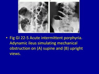 22 adynamic ileus | PPTX