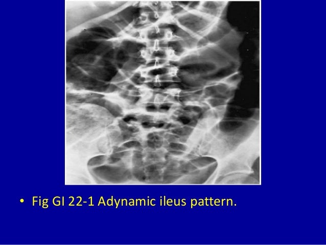 22 adynamic ileus