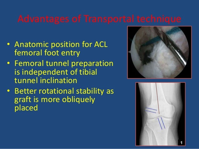 A Comparative Study of the Clinical and Functional Outcome Anterior C…