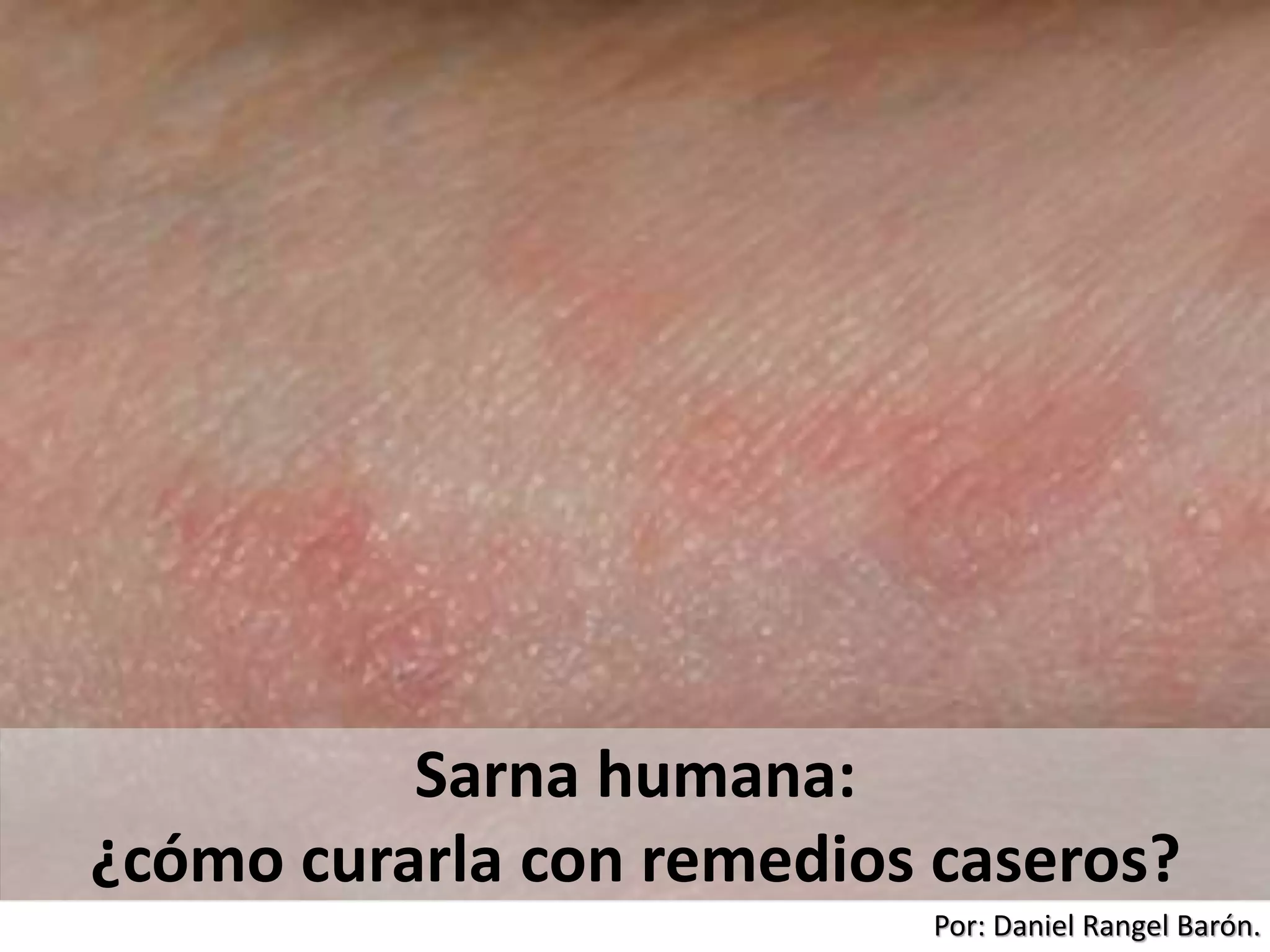Daniel Rangel Barón: Sarna humana: ¿cómo curarla con remedios caseros ...