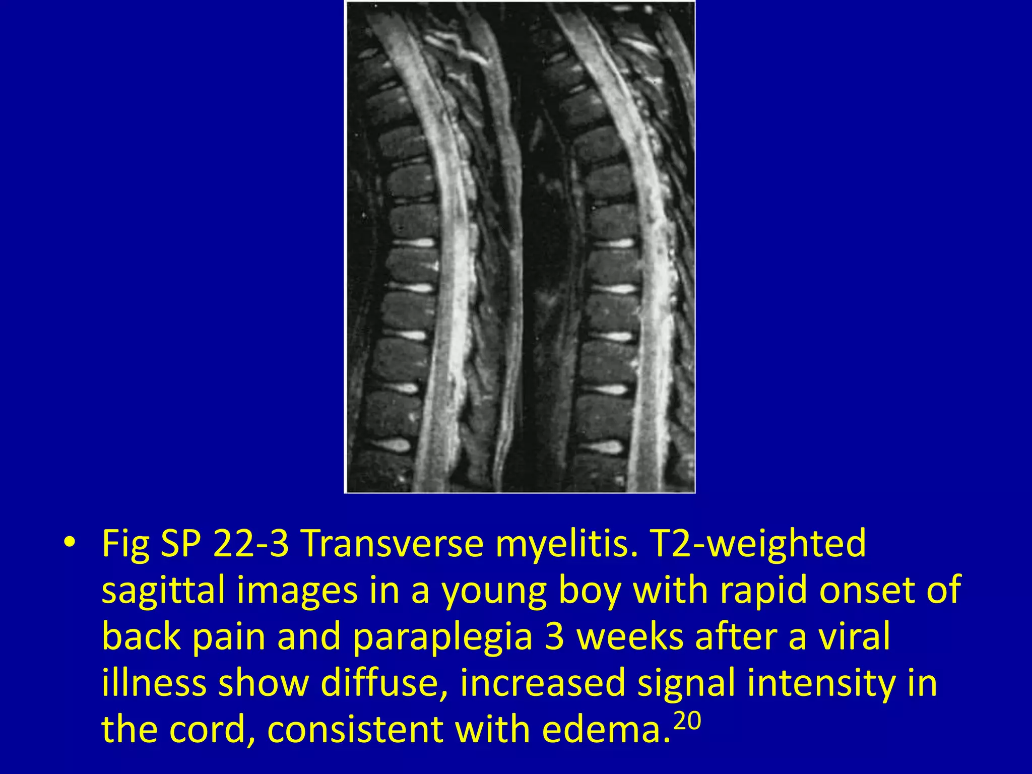 22 demyelinating and inflammatory disease of the spinal | PPTX