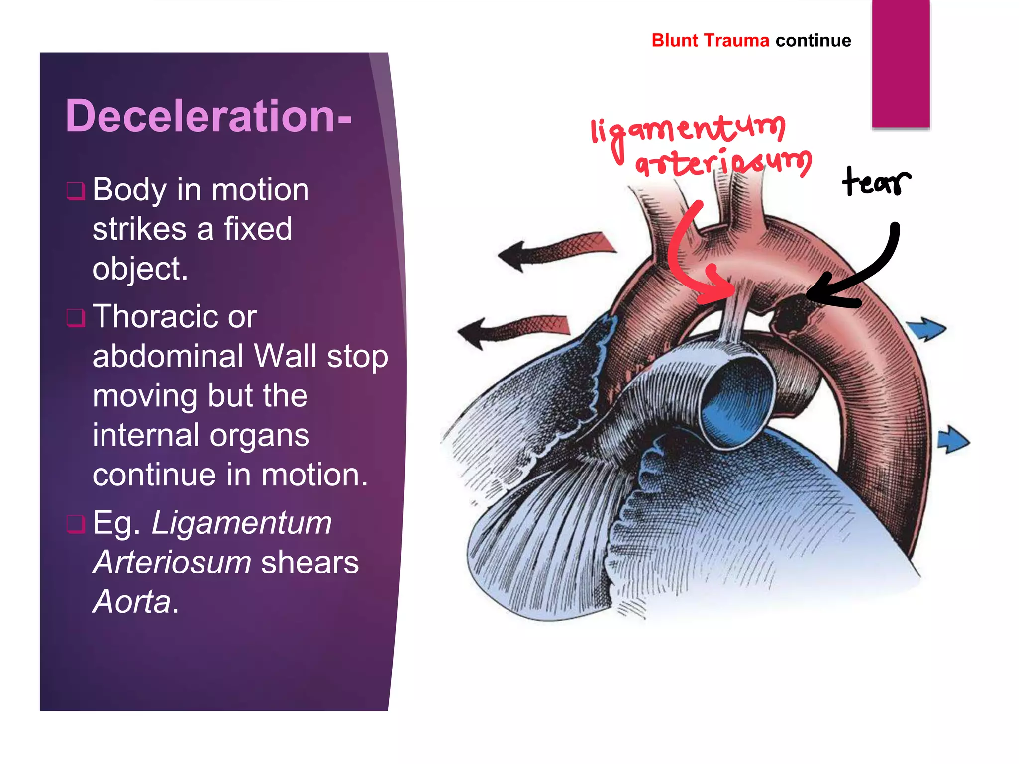 Mechanism of torso trauma - surgery | PPTX