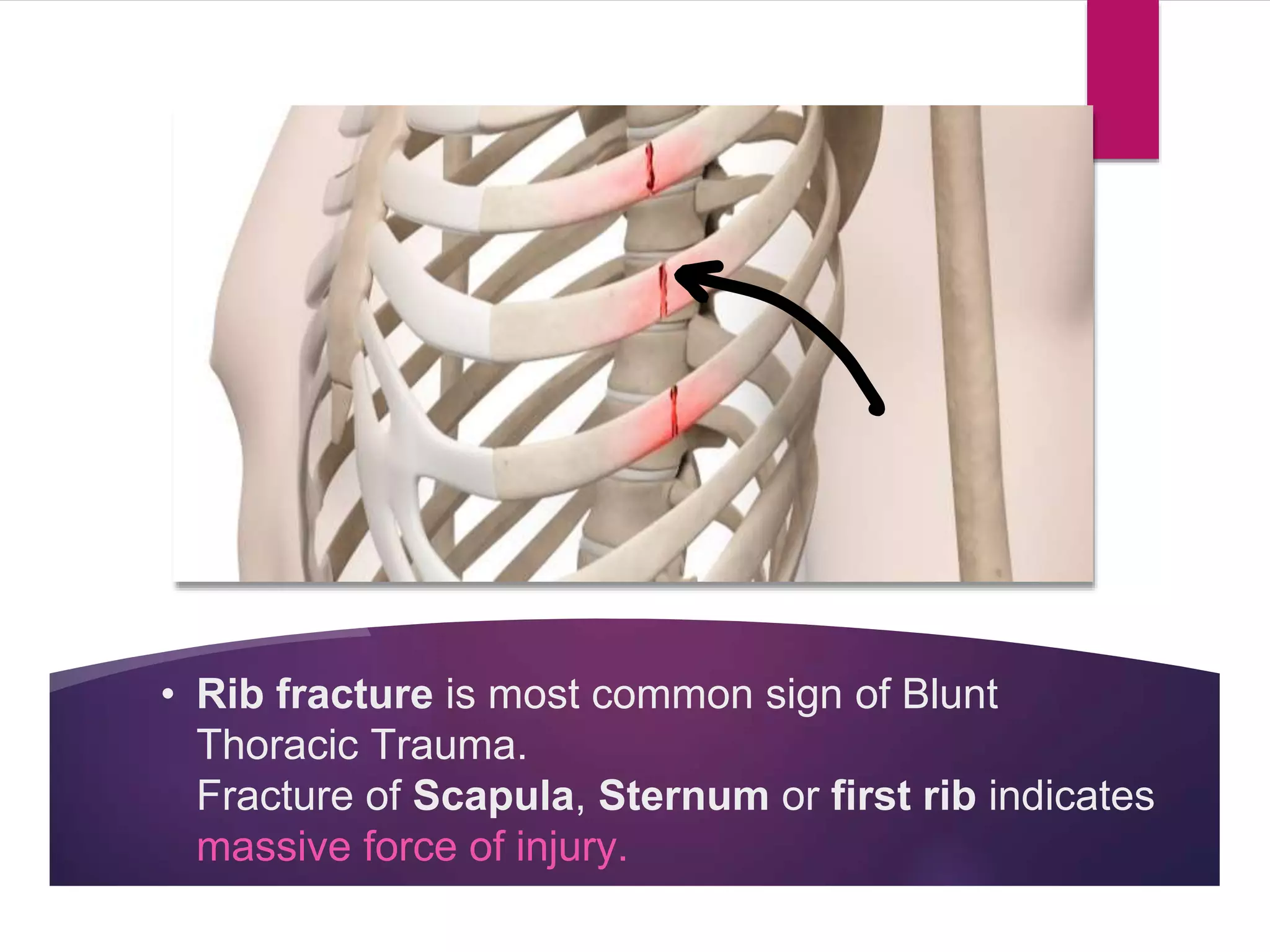 Mechanism of torso trauma - surgery | PPTX