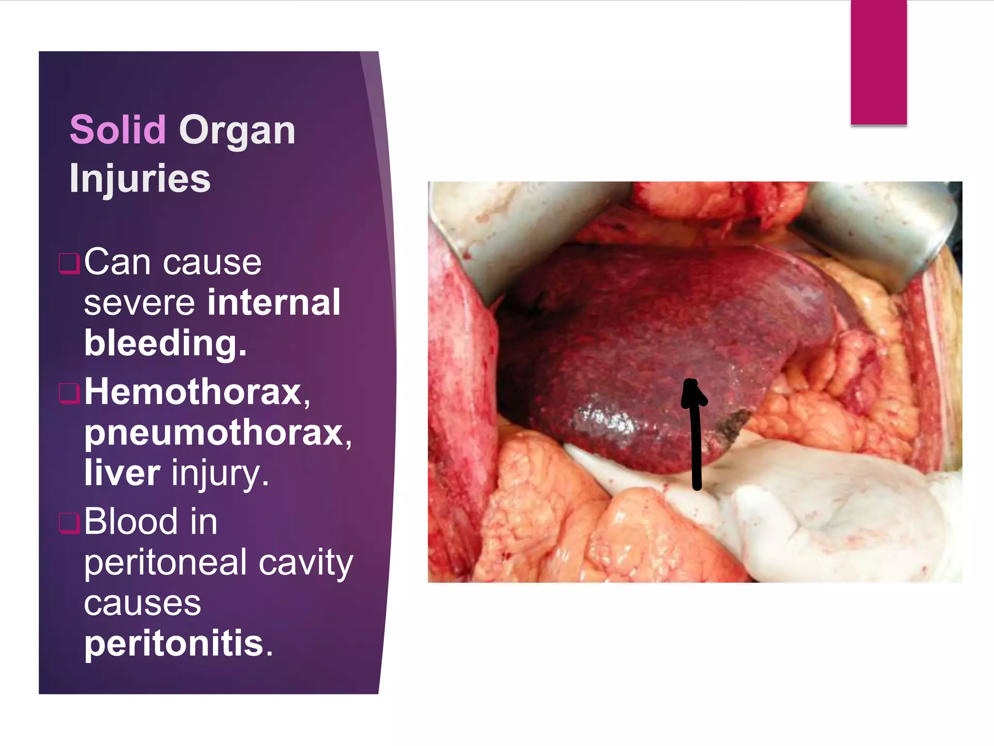 Mechanism of torso trauma - surgery | PPTX