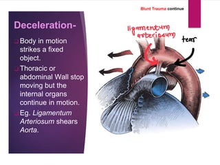 Mechanism of torso trauma - surgery | PPTX