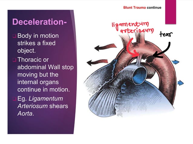 Mechanism of torso trauma - surgery | PPTX | Death, Injury, or Military ...