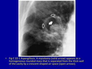 22 meniscus (air crescent) sign | PPTX