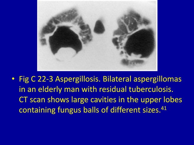 22 meniscus (air crescent) sign | PPT