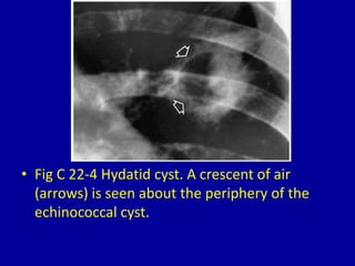 22 meniscus (air crescent) sign | PPTX