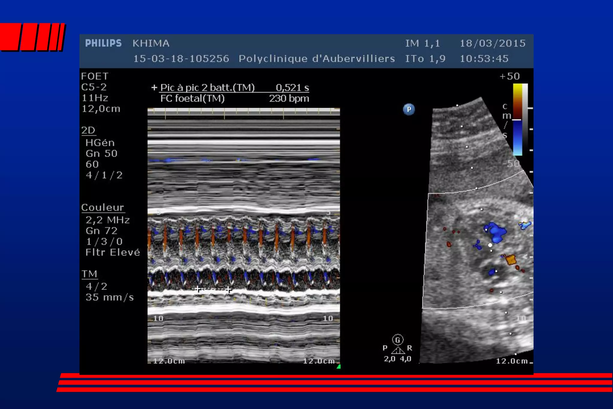 22 m guirgis fetal tachyarrhythmias | PDF